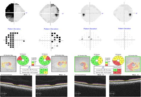 Post Partum Resolution Of Bitemporal Hemianopia With Persisting Pituitary Adenoma Canadian