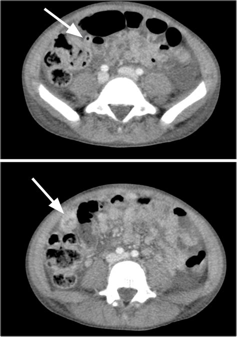 Contrast Enhanced Abdominal CT A A Long Appendix With Normal