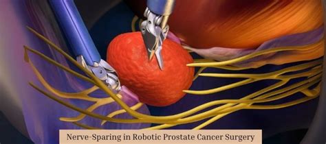 Robotic Prostate Cancer Surgery Benefits And Recovery