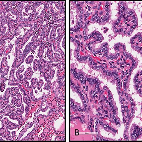 Overview Of The 2022 Who Classification Of Thyroid Neoplasms Request Pdf