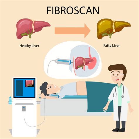 Liver Fibroscan Score Table My Xxx Hot Girl