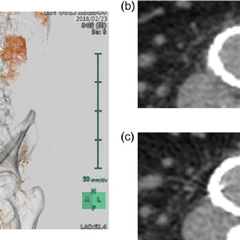 A Preoperative Ct Image With Three Dimensional Reconstruction Showing Download Scientific