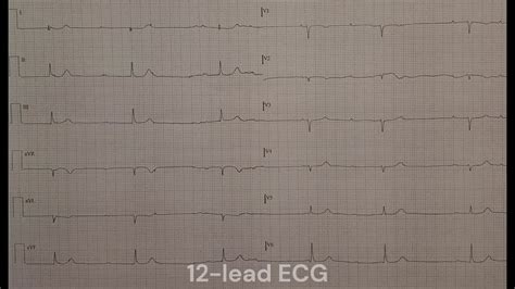 Carlo De Innocentiis On Linkedin Conduction System Pacing Csp To