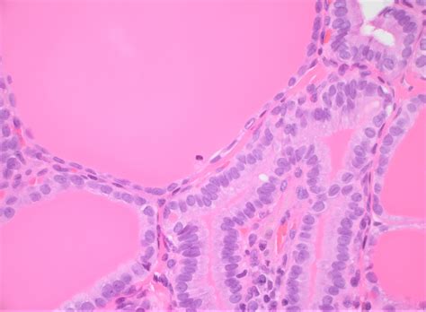 Pathology Outlines Macrofollicular