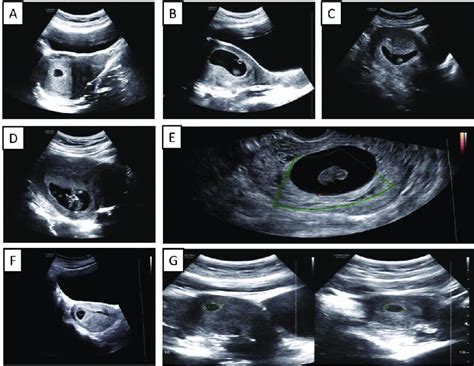Ultrasonography Detection Of Yolk Sac In Pregnant Women Within 12 Weeks