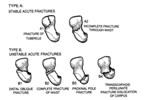 Scaphoid Fracture Classification