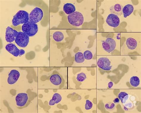 Plasma Cell Myeloma 3