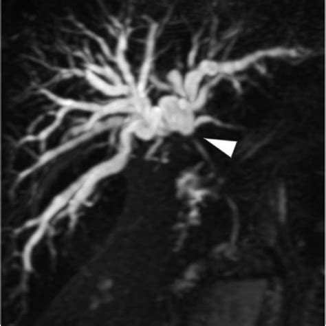Abdominal Contrast Ct Examination Findings Of Left Sided Bismuth Iv Download Scientific Diagram