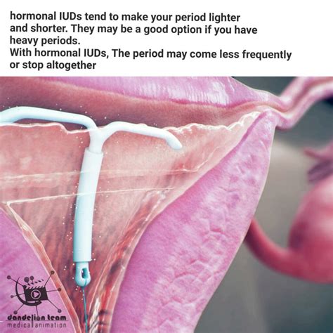 The Iuds Are Divided Into 2 Main Types Dandelion Team