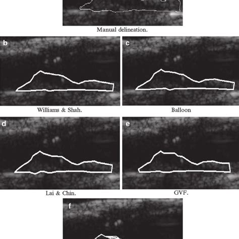 5 Plaque Segmentation Results On A Longitudinal Ultrasound B Mode Image