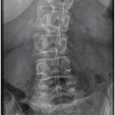 Plain Radiograph Of Patient 3 Showing Signs Of Sacroiliitis On The Download Scientific Diagram