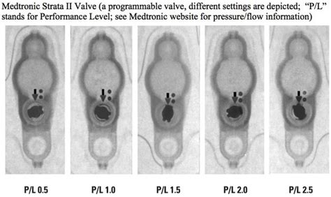 Brg Reading Skull Films For Shunt Valve Settings