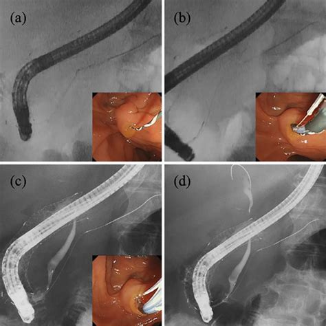 Figure7 Case Of Hilar Cholangiocarcinoma A Pancreatography Is Only Download Scientific