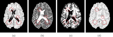 PDF Boosting Multiple Sclerosis Lesion Segmentation Through Attention Mechanism Semantic Scholar