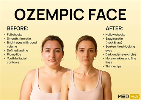 “ozempic Face” And Facial Ageing After Rapid Weight Loss What It Is And