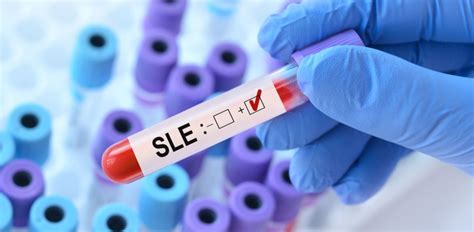 Lupus Clusters Show Distinct Disease Patterns Conexiant