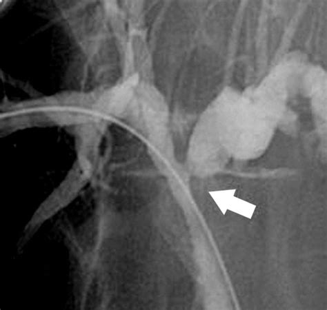Mimics Of Cholangiocarcinoma Spectrum Of Disease Radiographics