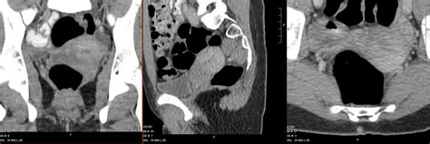 Was Trying To See If I Could Find My Retrocecal Appendix On My Old Er