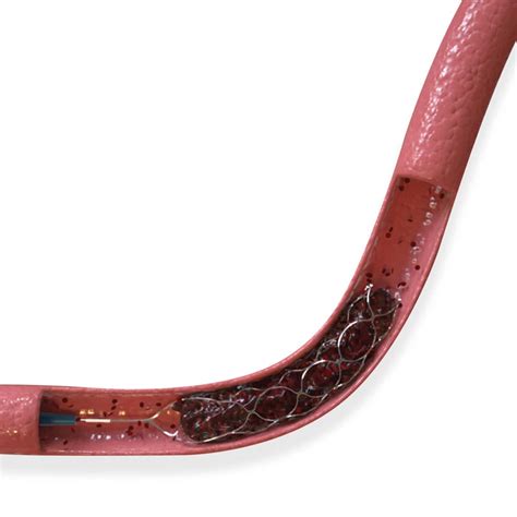 Invamed Research And Development King Vascular Revascularization Device