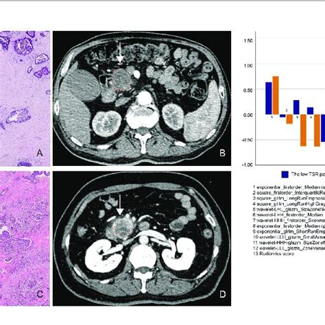 A Comparison Between Patients With Low And High Tumor Stroma Ratio