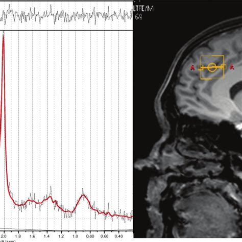 placement of anterior cingulate cortex voxel right panel and