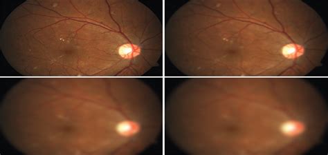 Indian Journal Of Ophthalmology