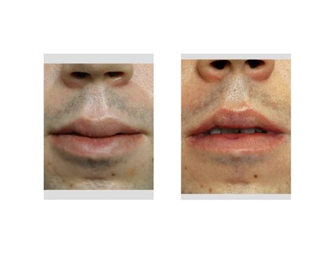 Xiphoidectomy Cpt Xiphoid Process Pain Causes Symptoms Home Remedies