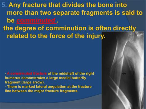 Bone Trauma Common Fractures Long Boneppt
