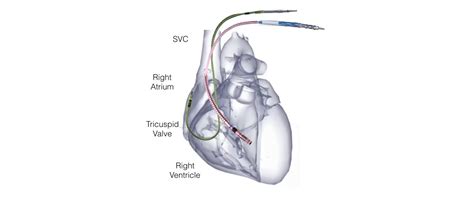 Defibrillator Aicd Implantation One Heart Cardiology
