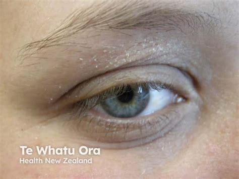 Eyelid Dermatitis Treatment Symptoms And Causes Eyelid Dermatitis