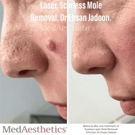 Laser Wart Removal Perth Medaesthetics