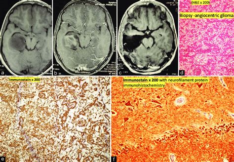 A C The Patient Underwent Amtr Histopathology Showing Mildly Download Scientific Diagram