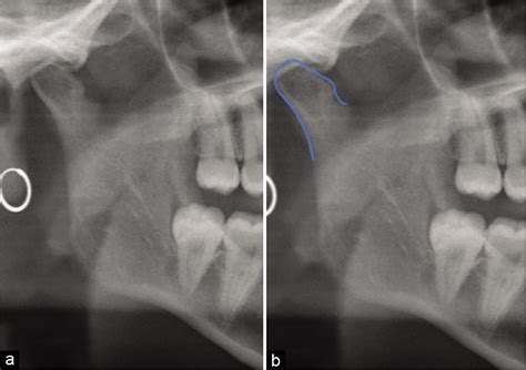 Optimal Use Of A Panoramic Radiograph As A Screening Tool For Condylar