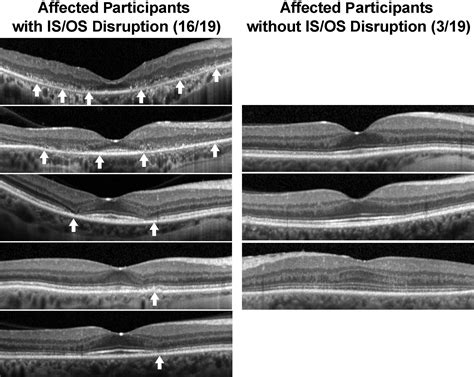 Subjective And Objective Screening Tests For Hydroxychloroquine