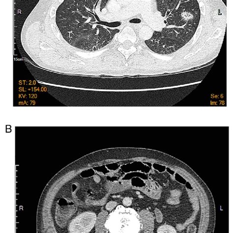 Pdf Gangrenous Cellulitis Caused By Coagulase‑negative Staphylococcus