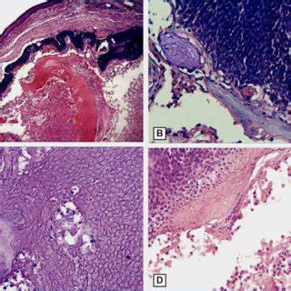 Pdf Pilomatrixoma Of The Eyelid