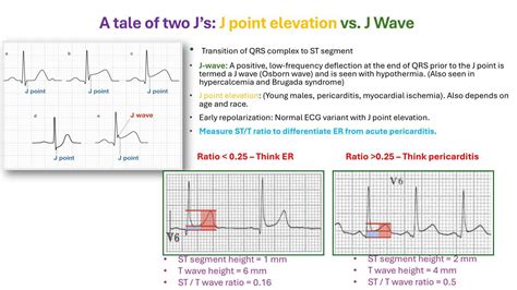 Medpic It Is Important To Differentiate J Wave From J Point Stt