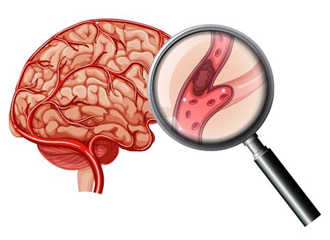 ประเภทของโรคหลอดเลือดสมอง แบ่งออกเป็น 2 ประเภท