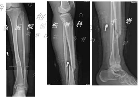 胫骨骨折治疗金标准 髓内钉，难点、技巧汇总！ 好医术文章 好医术 赋能医生守护生命