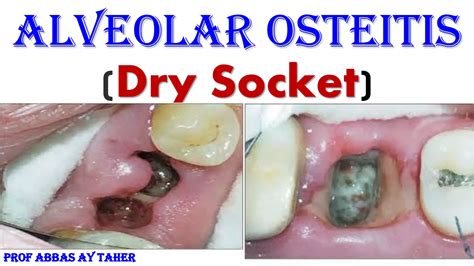 Alveolar Osteitis Dry Socket Pdf