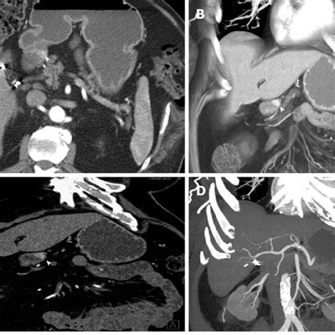 Duodenal Carcinoid A 80 Year Old Male With Duodenal Carcinoid Upper
