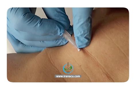 امبدینگ شکم چیست؟