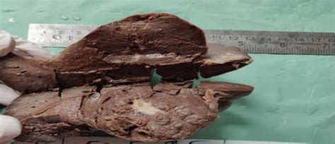 Splenectomy Specimen Showing Well Circumscribed Mass And A Scar On Cut