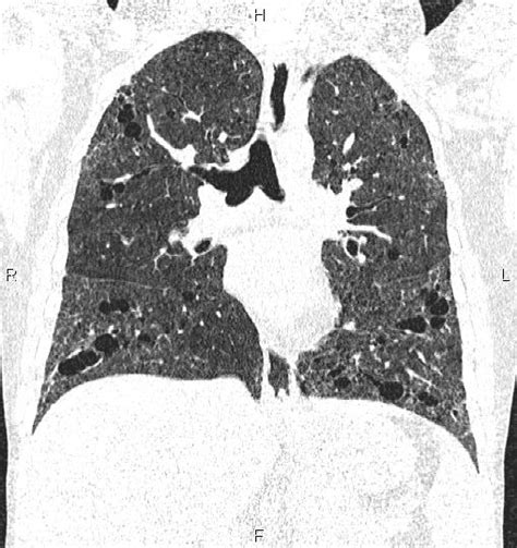 Scleroderma Related Interstitial Lung Disease Image