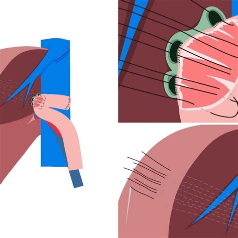 Anatomical Illustration After Left Hemihepatectomy Download Scientific Diagram