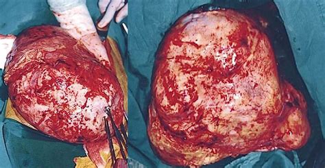 Macroscopic View Of An Intestinal Gist Once Exteriorized And Completely