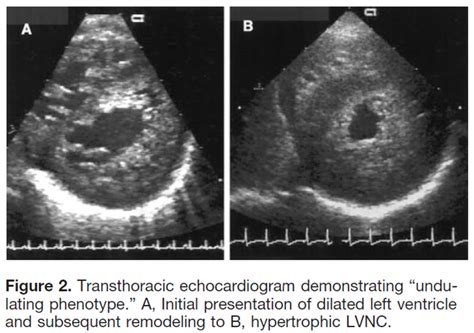 Pedi Cardiology LV Non Compaction