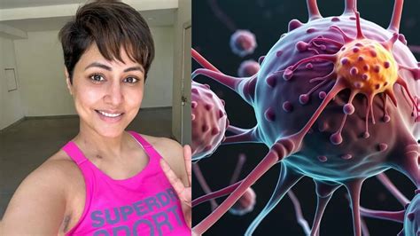 Breast Cancer क्या ब्रेस्ट कैंसर के इलाज के बीच एक्सरसाइज करना सेफ है