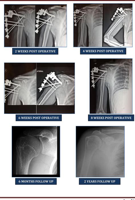 Figure 6 Surgical Management Of Proximal Humerus Fracture