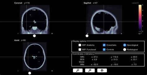 Whole Brain Source Analysis Fft And Mni Space Discussions Brainstorm